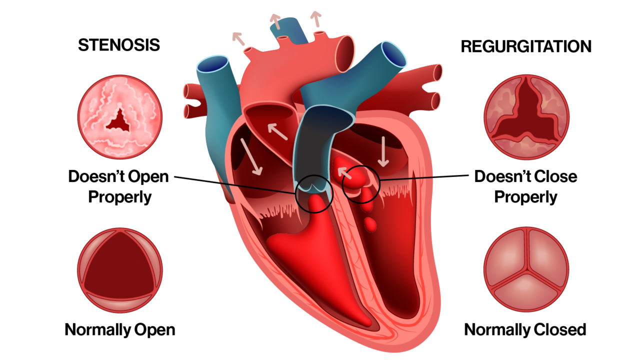 What is Valve Disease? - Heart Valve Disease Awareness Day